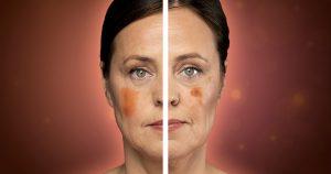 Age Spots vs Melanoma: A Comparison Guide