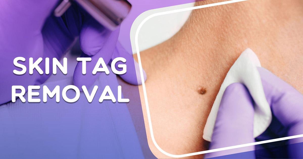 Skin Tag Removal: A Comprehensive Guide to Costs & Procedures