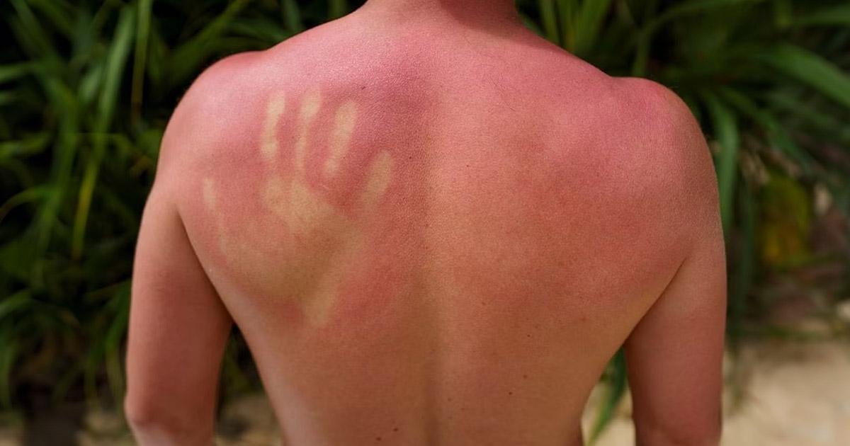 Are You Experiencing Sun Poisoning or Sunburn?