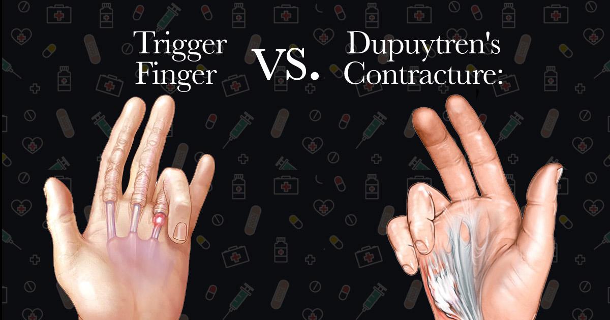 Main Differences of Trigger Finger & Dupuytren's Contracture