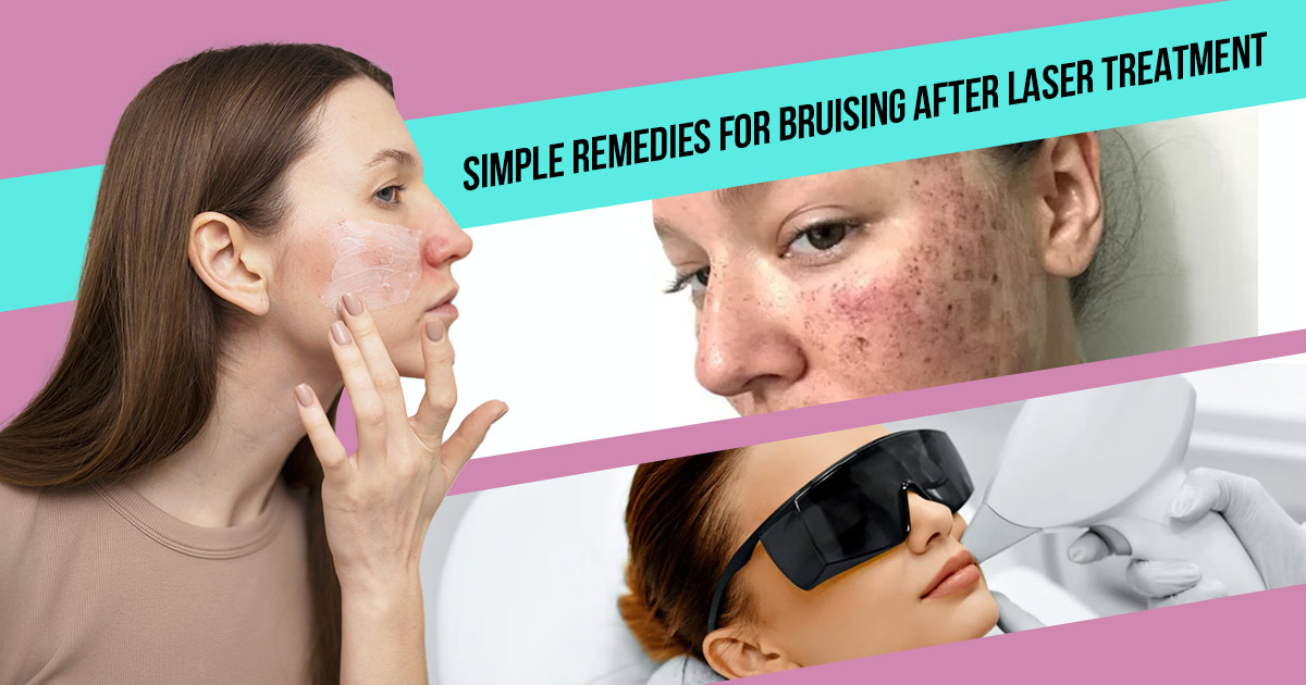Simple Remedies for Bruising After Laser Treatment