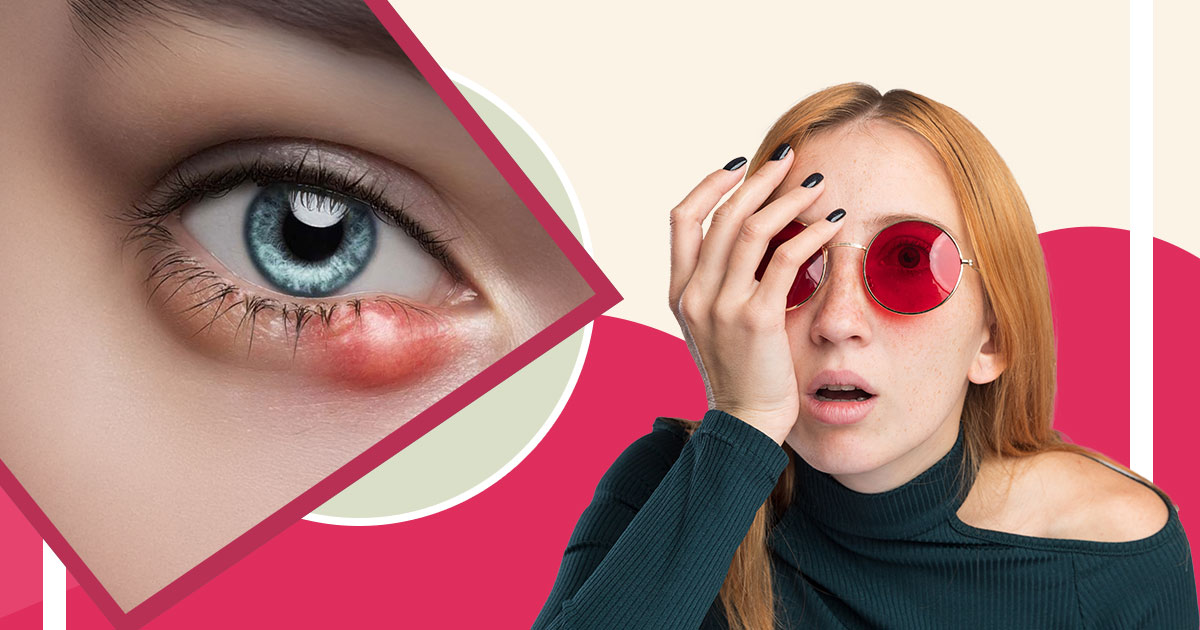 How Allergies Can Trigger a Stye – The Link Explained