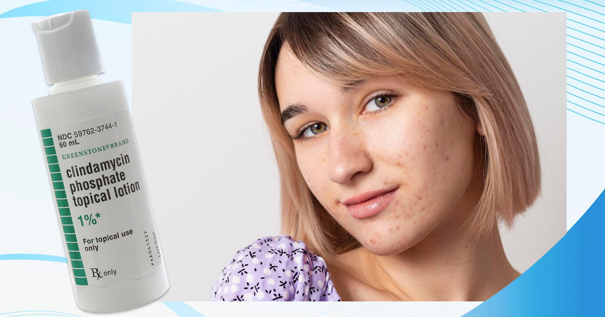 7 Steps That Make Clindamycin Work Better for Acne