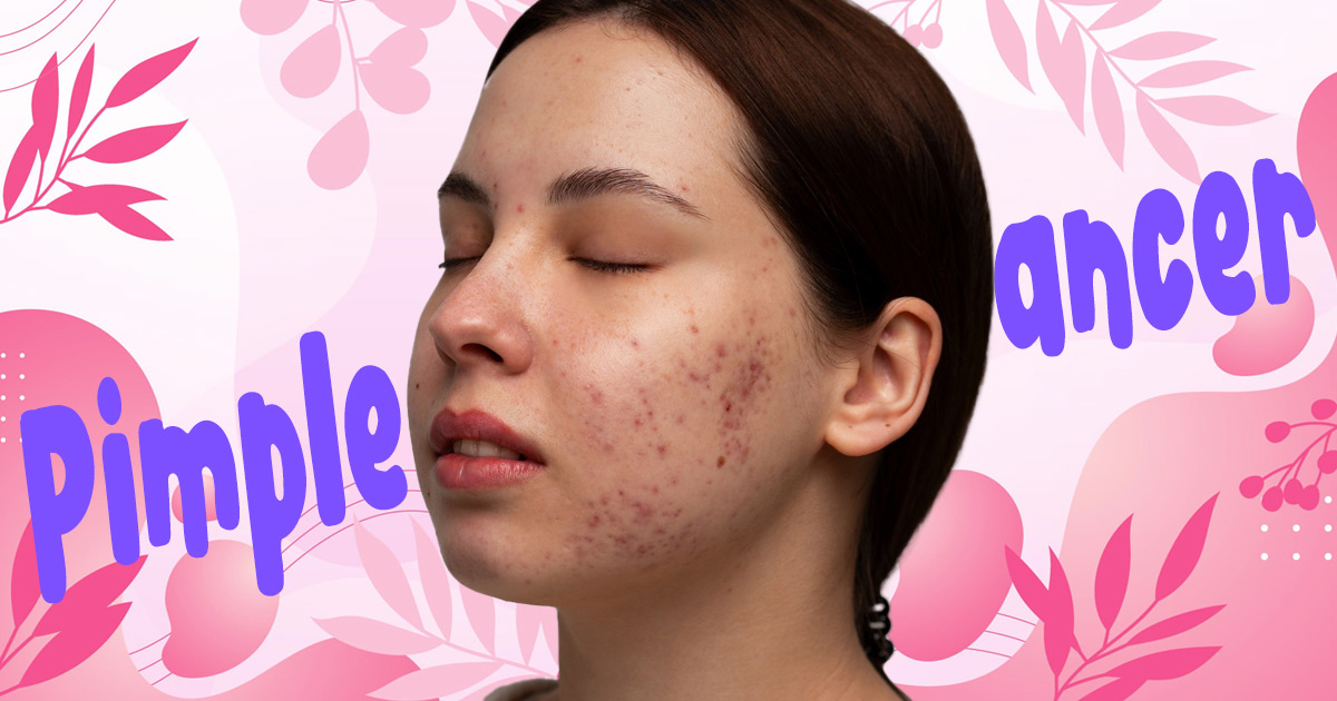 Is It a Pimple or Melanoma? Spot Skin Cancer Early