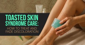 12 Effective Ways to Get Rid of Toasted Skin Syndrome