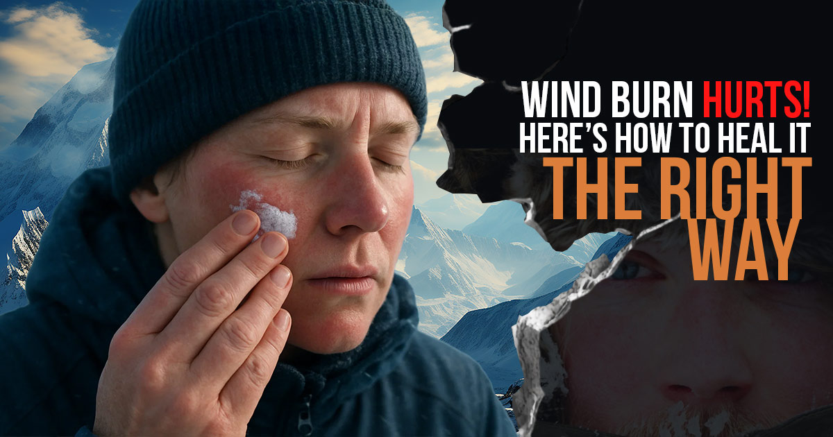 Why Wind Burn Happens, and How to Get Rid of It