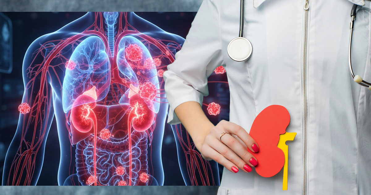 Kidney Cancer: Can It Spread & How Fast?